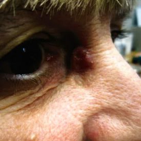 Facial Skin Cancer Surgery reconstruction - Harrogate and District NHS ...