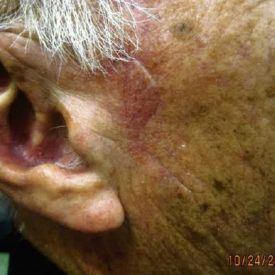 Facial Skin Cancer Surgery reconstruction - Harrogate and District NHS ...